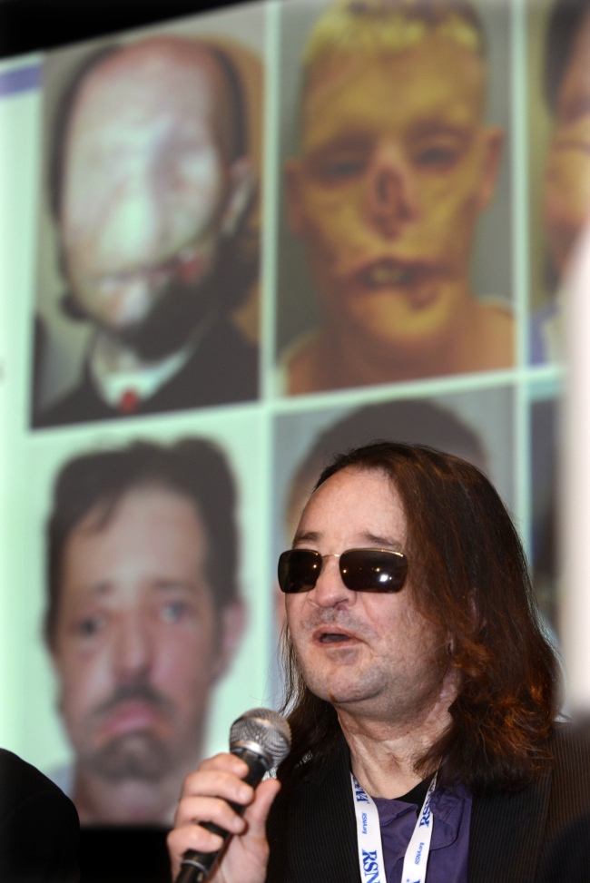 Face transplant patients thrive after operations - The Korea Herald