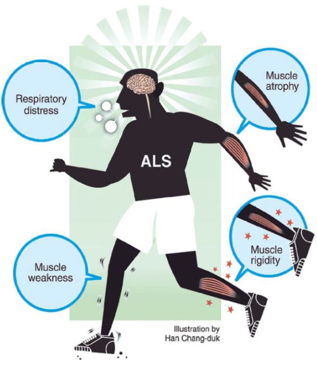 als chest muscle atrophy