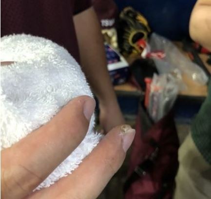 To treat blister, pitcher turns to urine - The Korea Herald